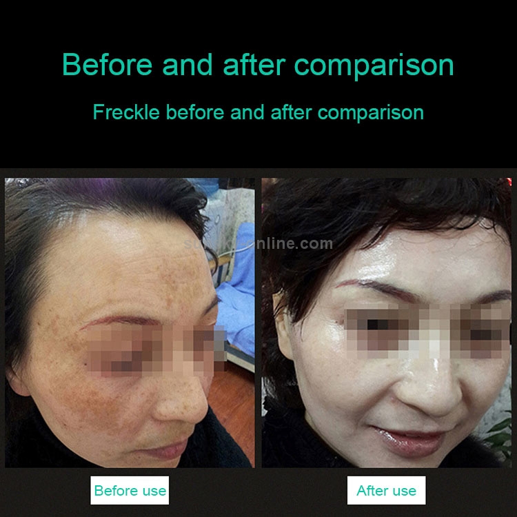 휴대용 피코 세컨드 휴대용 눈썹 타투 스팟 제거 기계 레이저 플라즈마 뷰티 케어 펜 Eu 플러그 빨간불